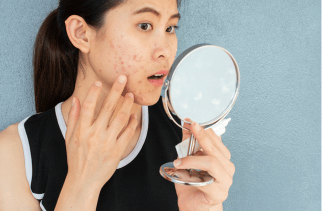 How To Deal With Acne - Stone Oak Dermatology