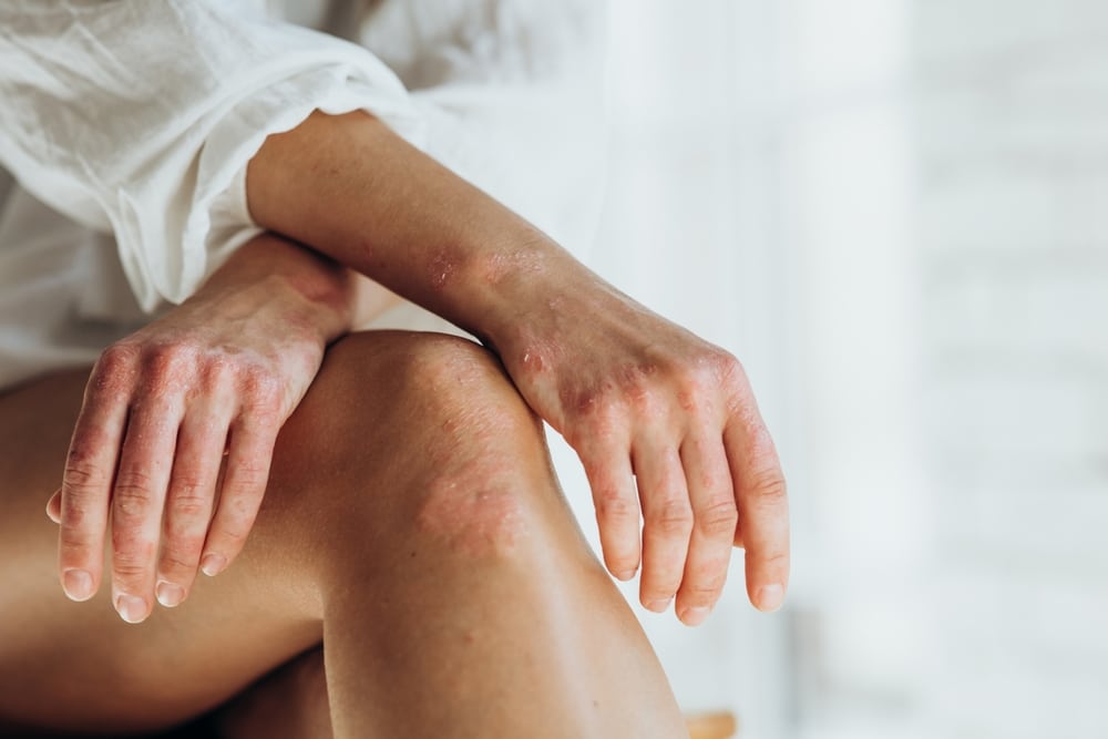 Manage Psoriasis During Changing Fall Weather - San Antonio, TX
